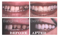 Irregular shape teeth Elaine had chipped upper teeth that were also ...