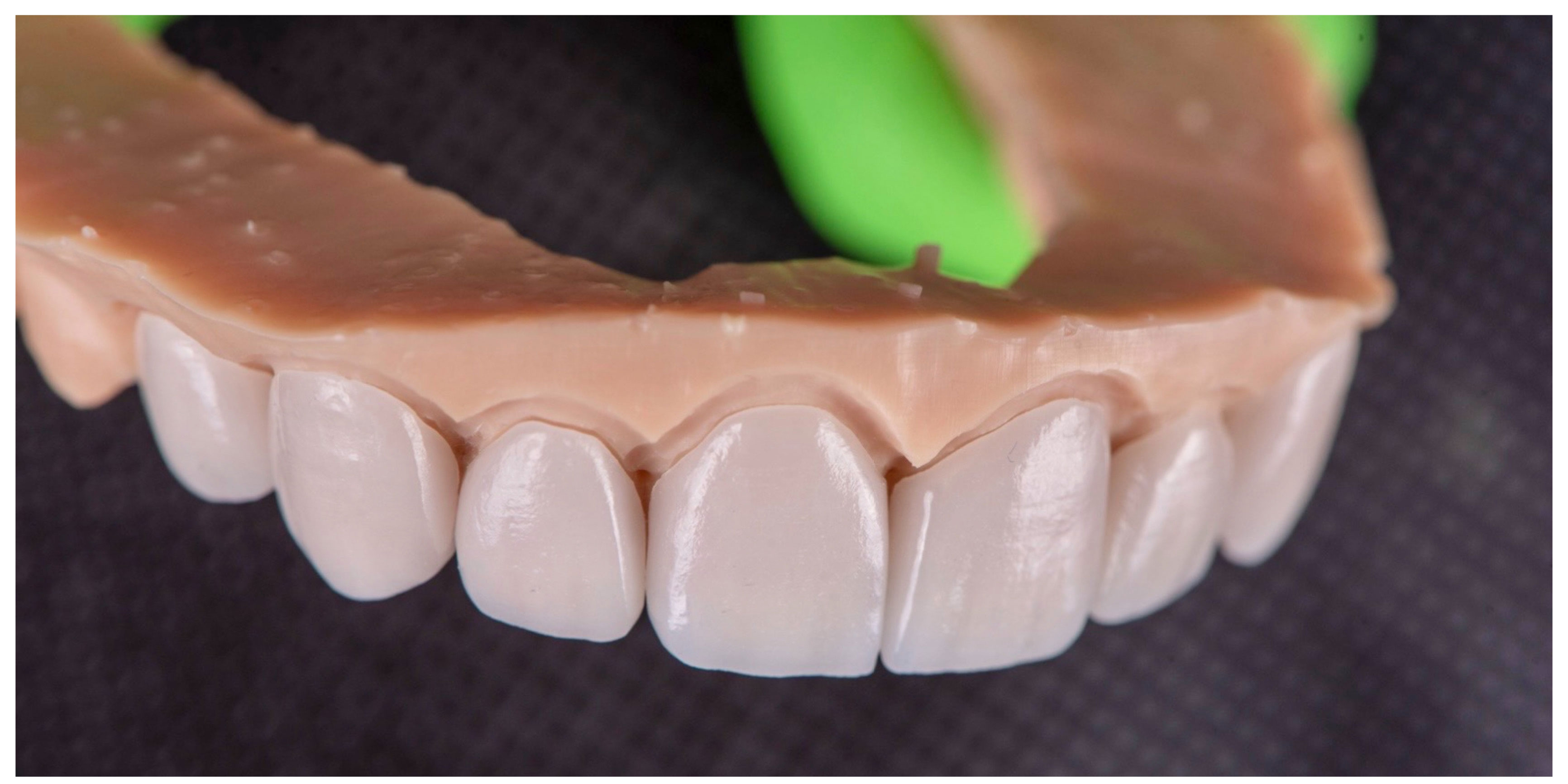 Digital Veneers Thailand - Bangkok Smile Dental MALO DENTAL