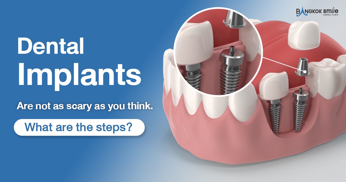 Getting Dental Implants: Not As Scary As You Think (A Simple Step-by ...