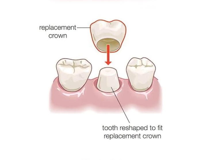 Dental Crown and Dental Bridge by Bangkok Smile Dental Clinic.
